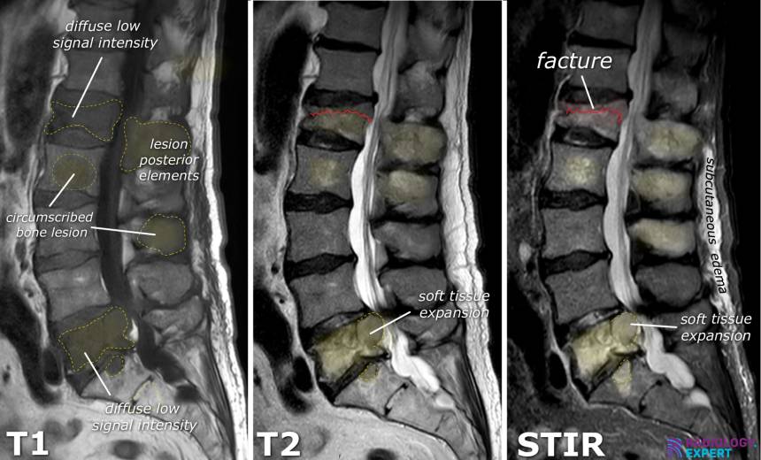 MRI Lumbar Spine